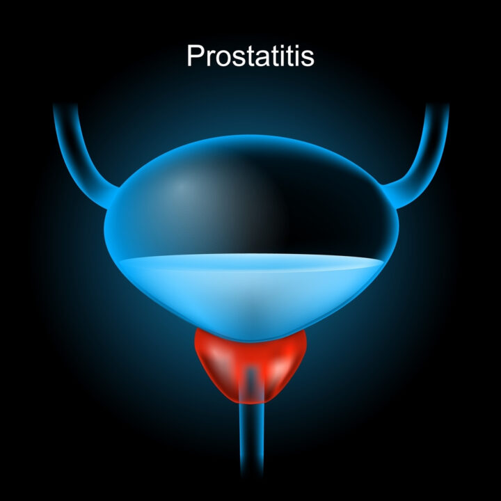 PROSTATITIS CRÓNICA – Dr. Emilio Garnique